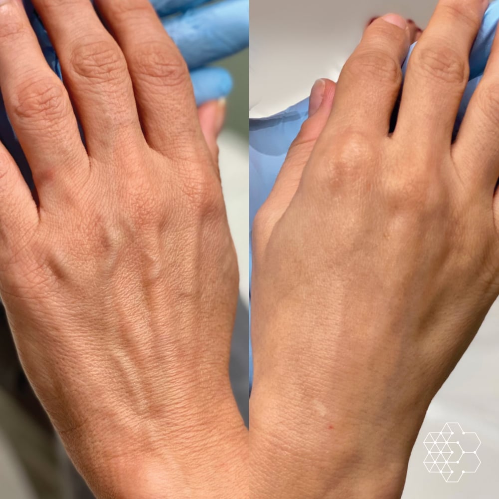 Filler Hand Treatment in Vancouver, BC | Skin Technique