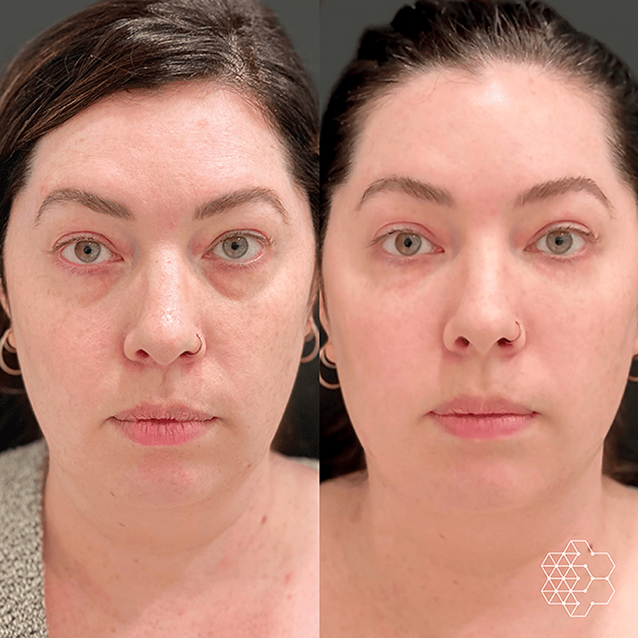 TiredEye™ Treatment in Vancouver | Clinic For A Rested Look