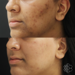 What Is BroadBand Light (BBL) Therapy and How Does It Work?