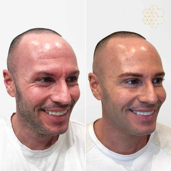 Yes, Laser Treatments are for Men Too - Skin Technique