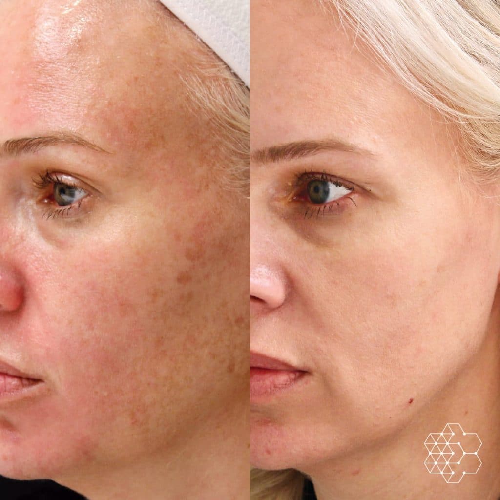 Microneedling vs. Chemical Peel: What’s the Real Deal? - Skin Technique