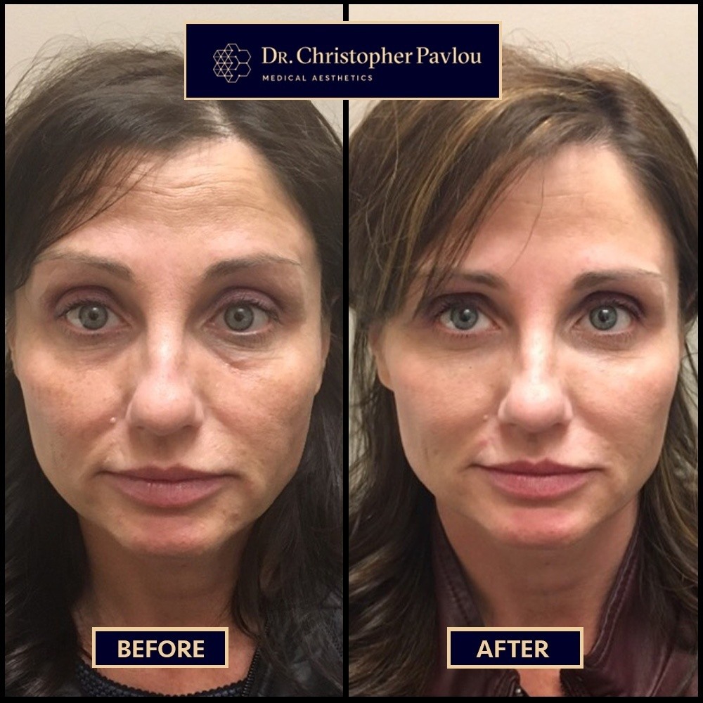 The Magical Liquid Lift - Skin Technique