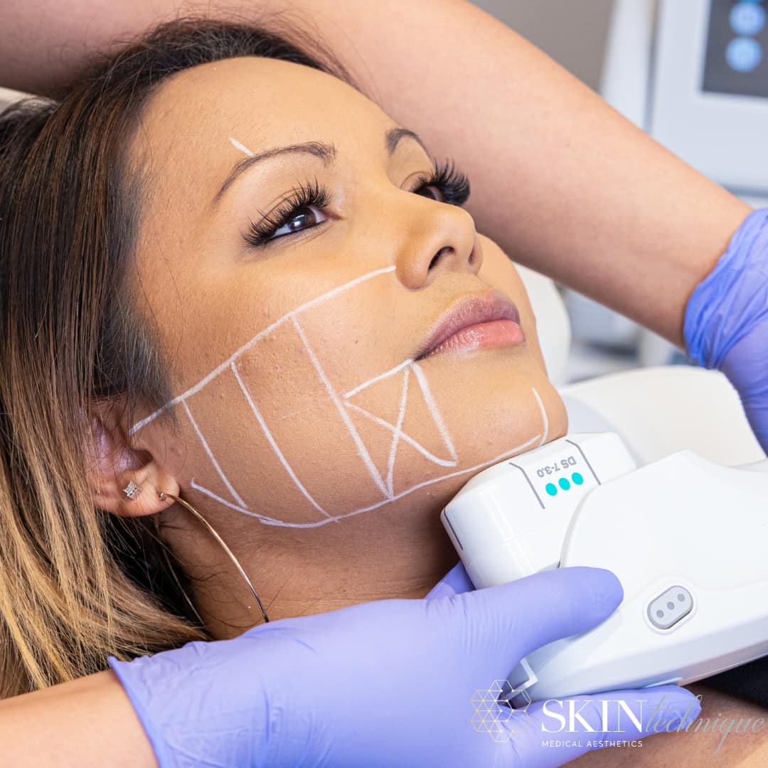 The Before and After of Ultherapy: Skin Technique’s Guide - Vancouver